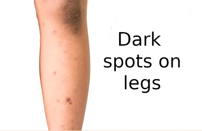 Dark spots on legs causes and solution